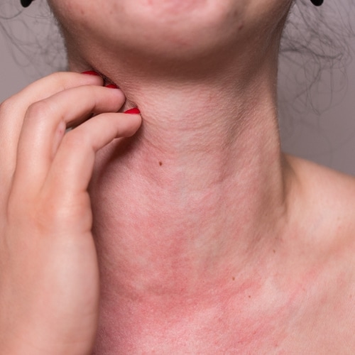 Alles over allergie symptomen - Geef Inzicht